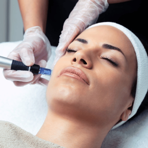 Vampire Facial: Experience Dramatic Skin Renewal with Results